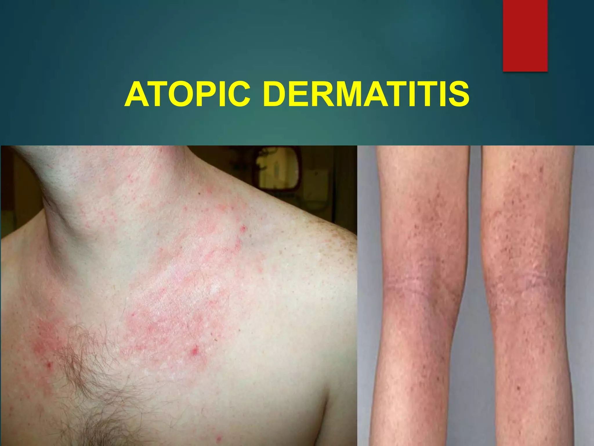 Common Skin Diseases | PPT