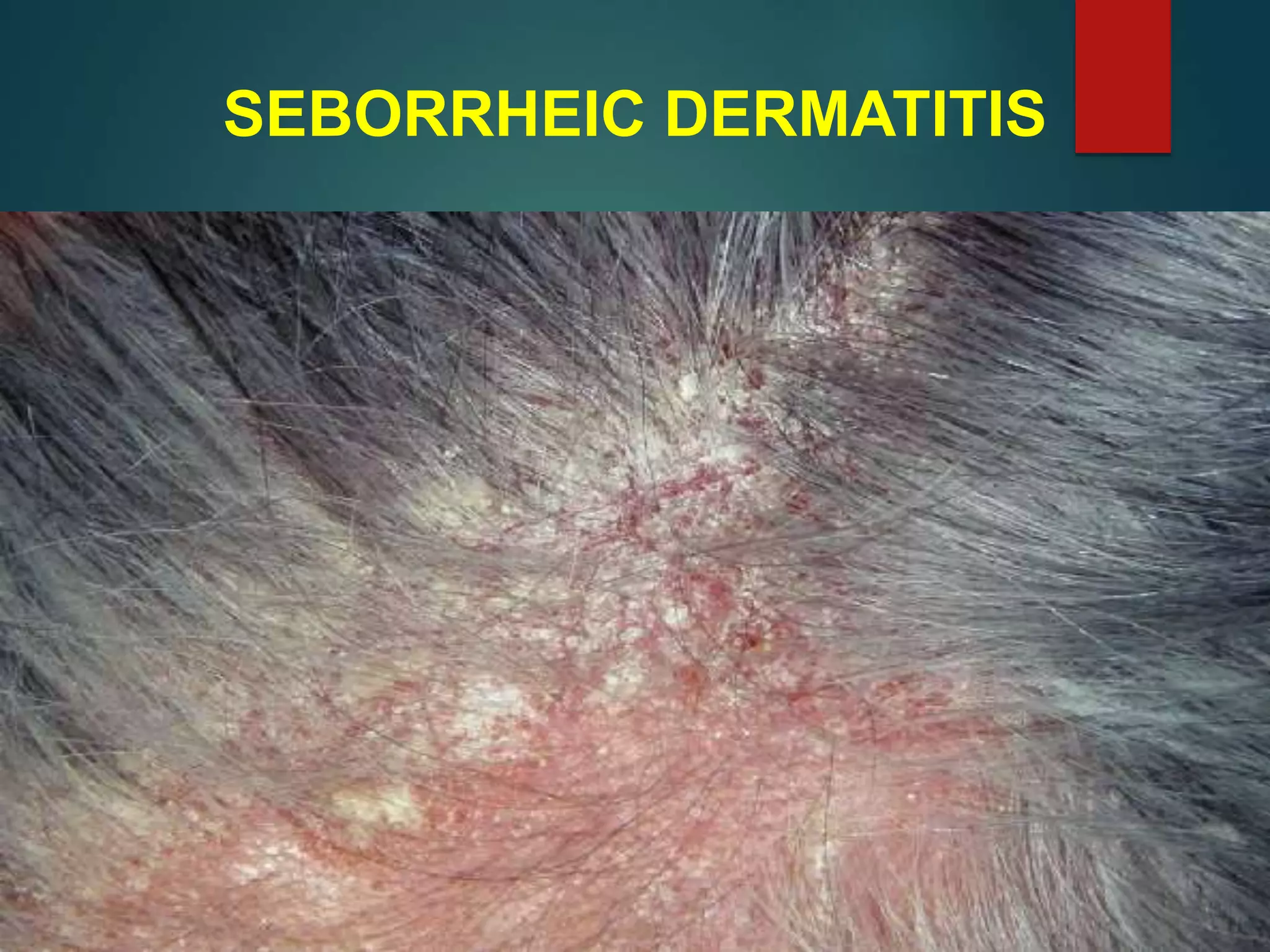Common Skin Diseases | PPT