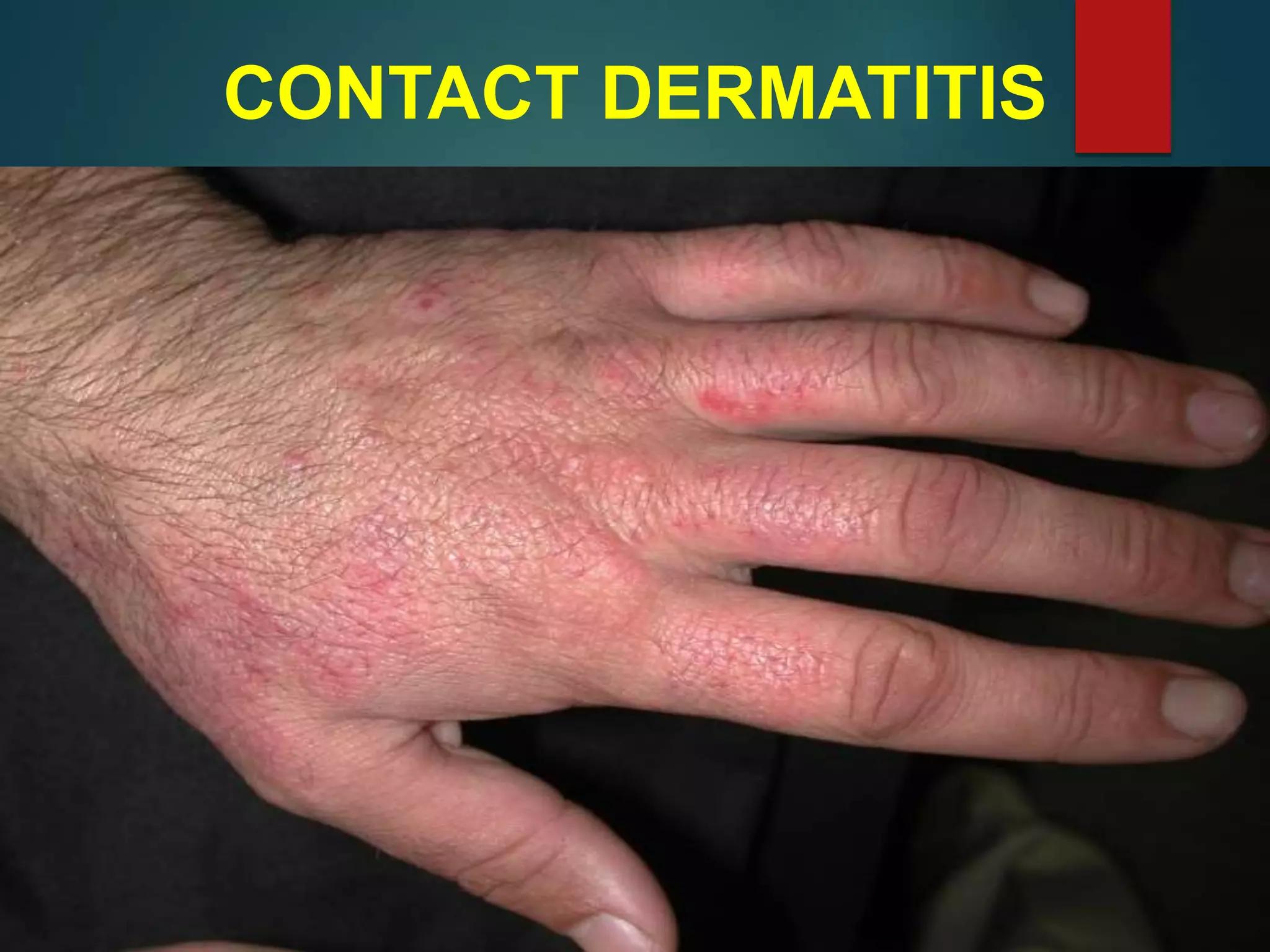 Common Skin Diseases | PPT