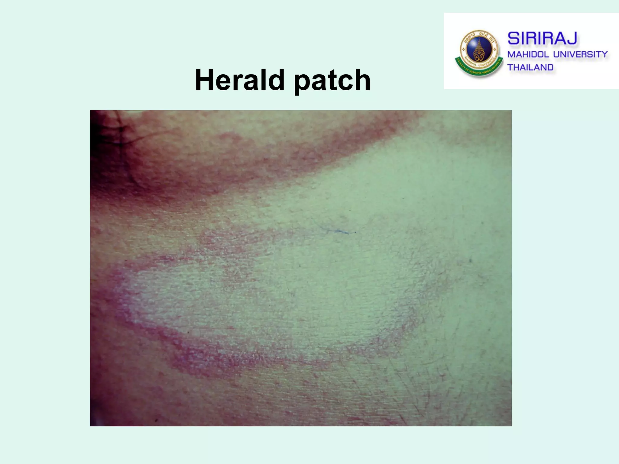 Common skin diseases | PDF