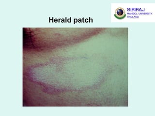 Common skin diseases | PDF
