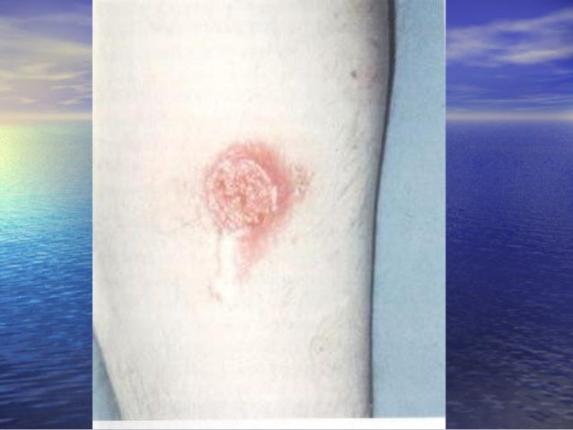 Common skin infections