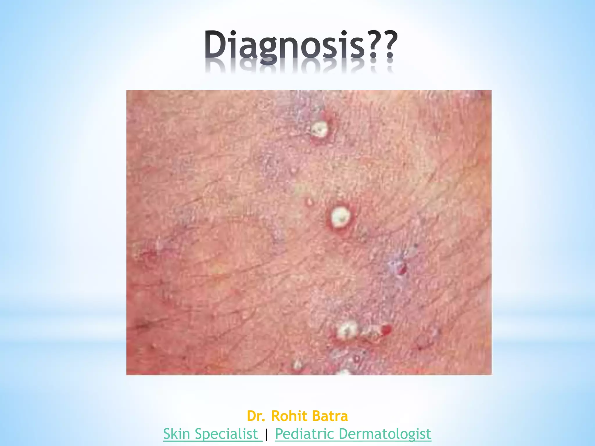 Common Skin Infections in Children | PPTX