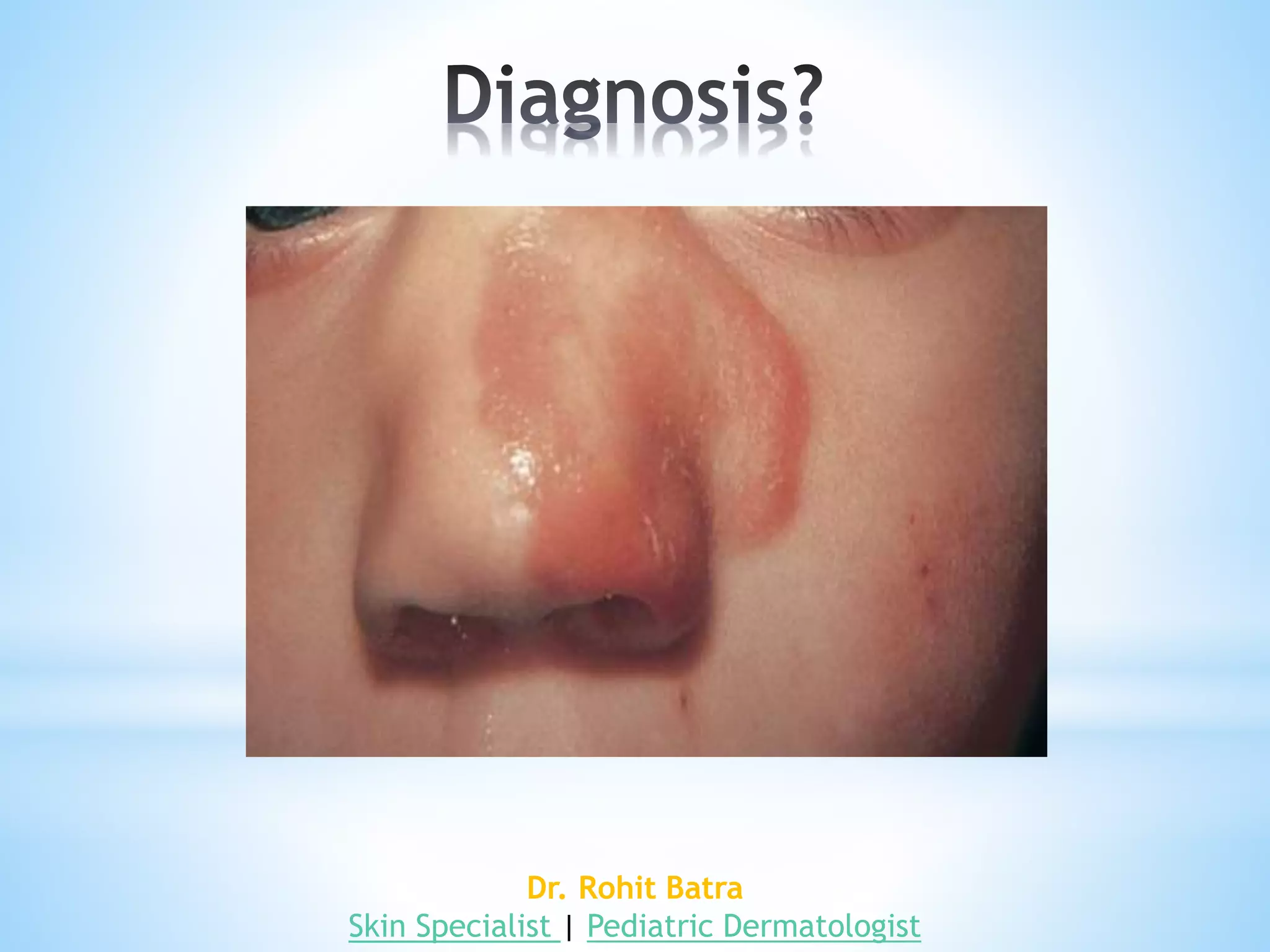 Common Skin Infections in Children | PPTX