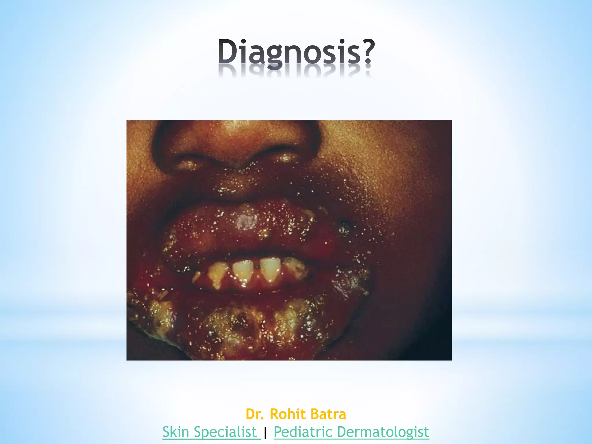 Common Skin Infections in Children | PPTX