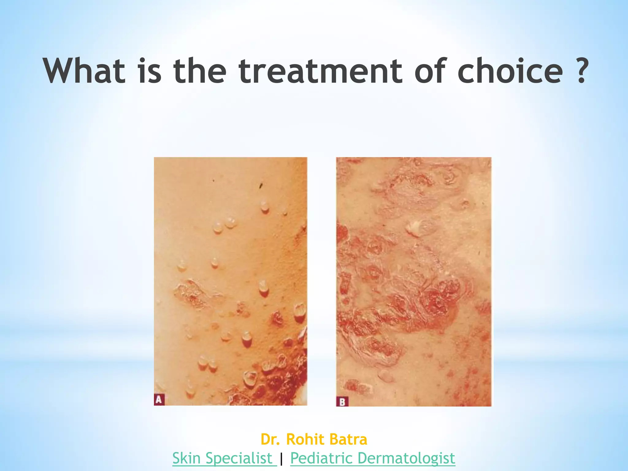 Common Skin Infections in Children | PPTX