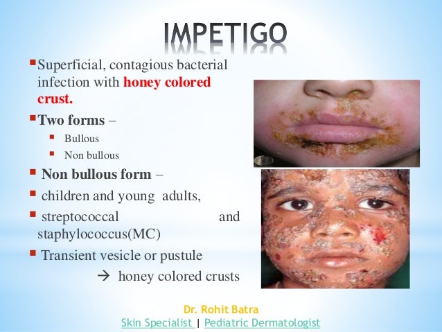 Common Skin Infections in Children