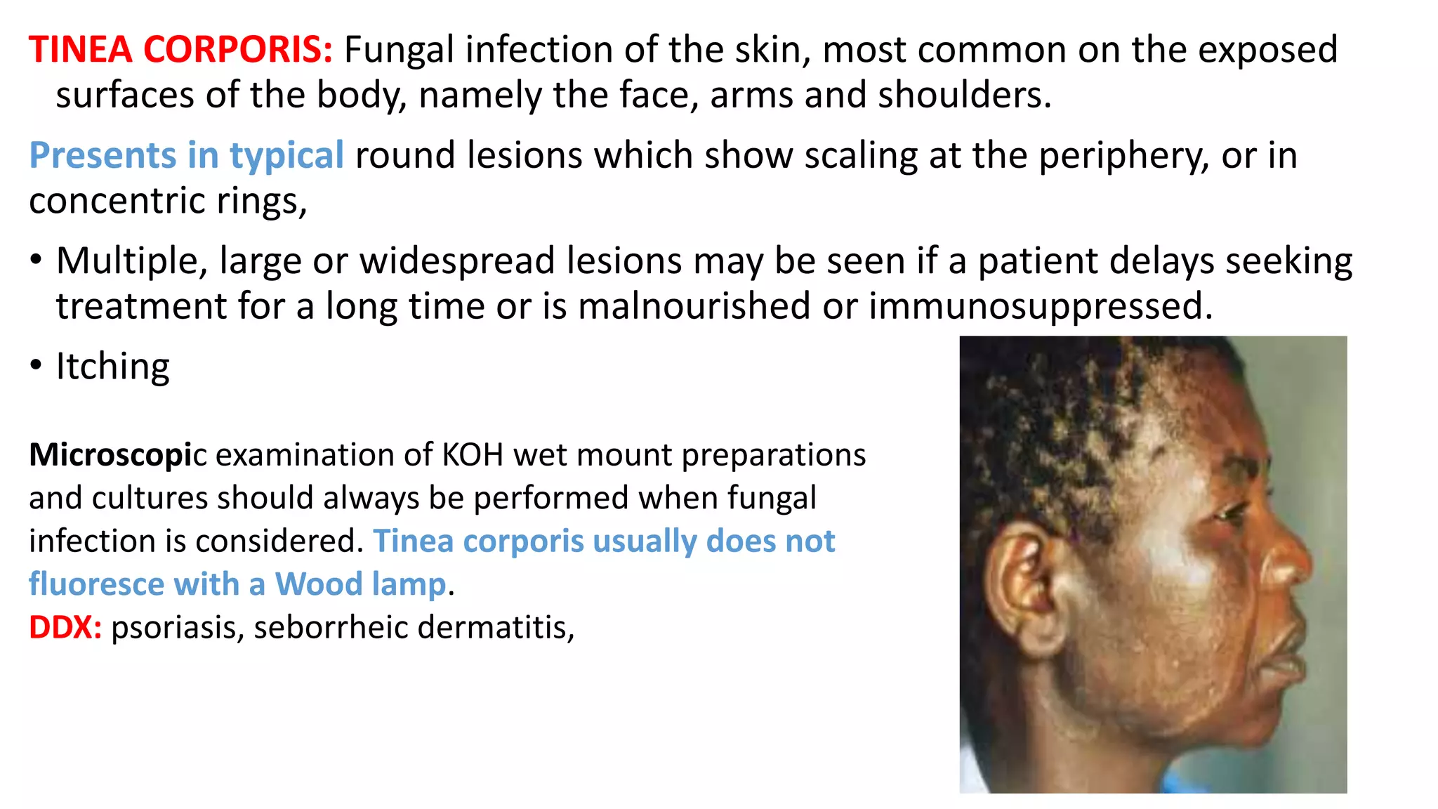 COMMON SKIN INFECTIONS IN CHILDREN.pptx | Skin and Dermatology ...