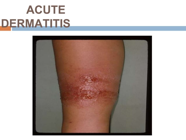 common skin inflammatory diseases.pptx