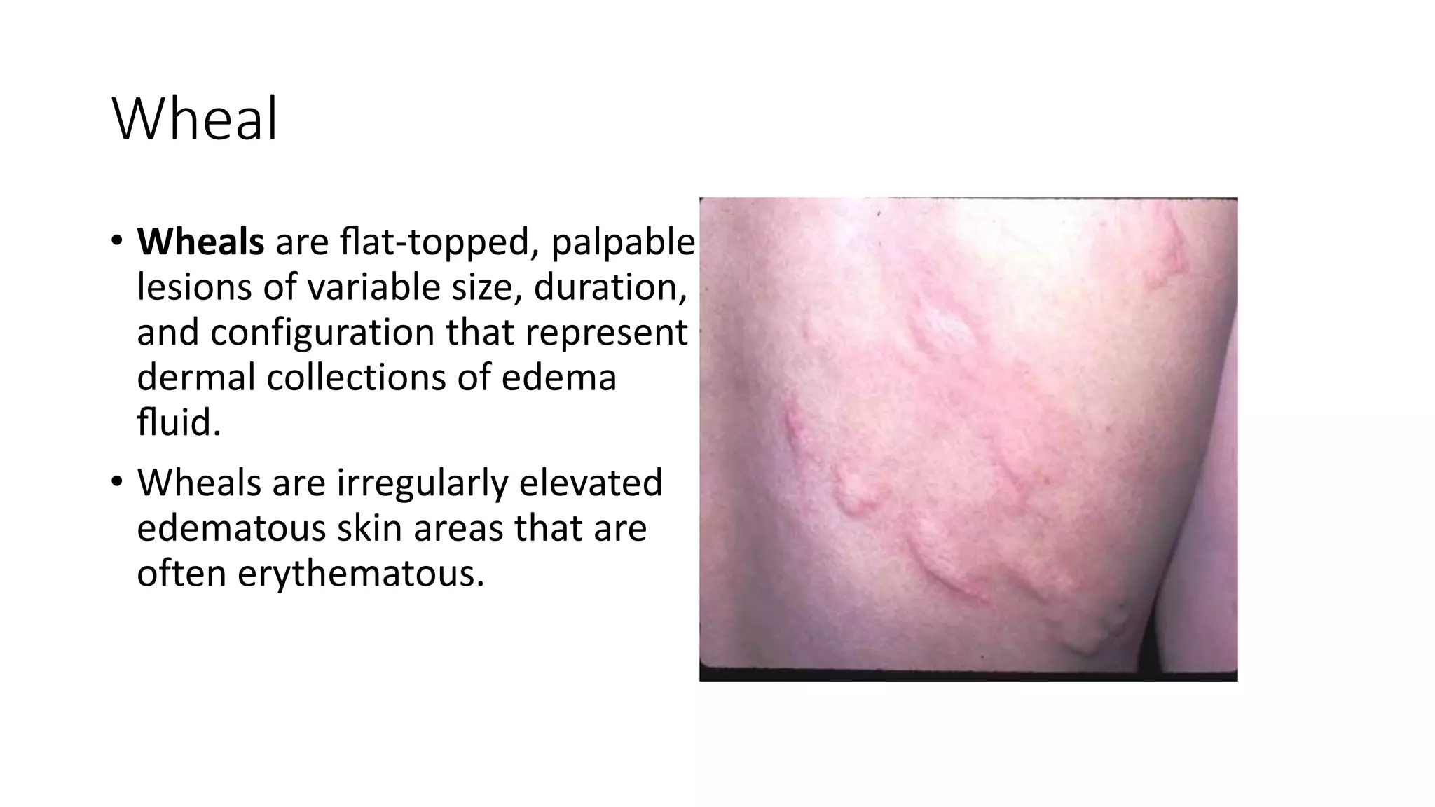 Common Skin Lesions in Pediatrics.pptx
