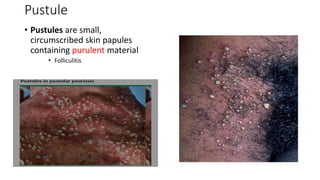 Common Skin Lesions in Pediatrics.pptx