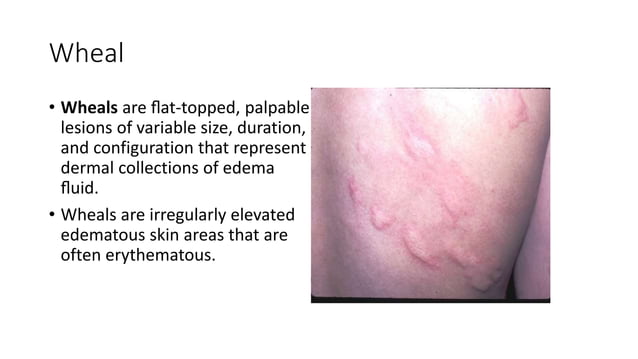Common Skin Lesions in Pediatrics.pptx | Skin and Dermatology ...