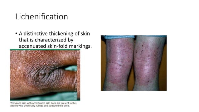 Common Skin Lesions in Pediatrics.pptx | Skin and Dermatology ...