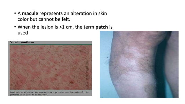 Common Skin Lesions in Pediatrics.pptx | Skin and Dermatology ...