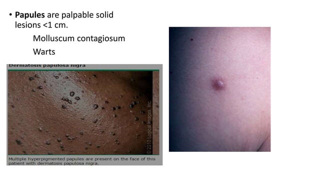 Common Skin Lesions in Pediatrics.pptx | Skin and Dermatology ...