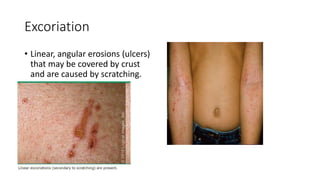 Excoriation Skin Lesion