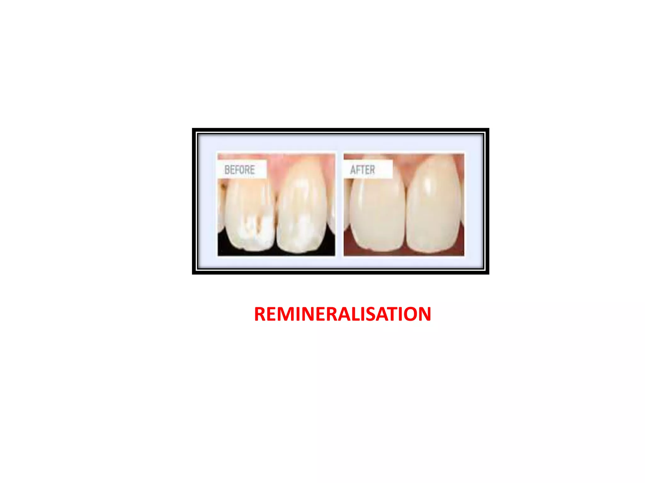 Remineralization | PPTX