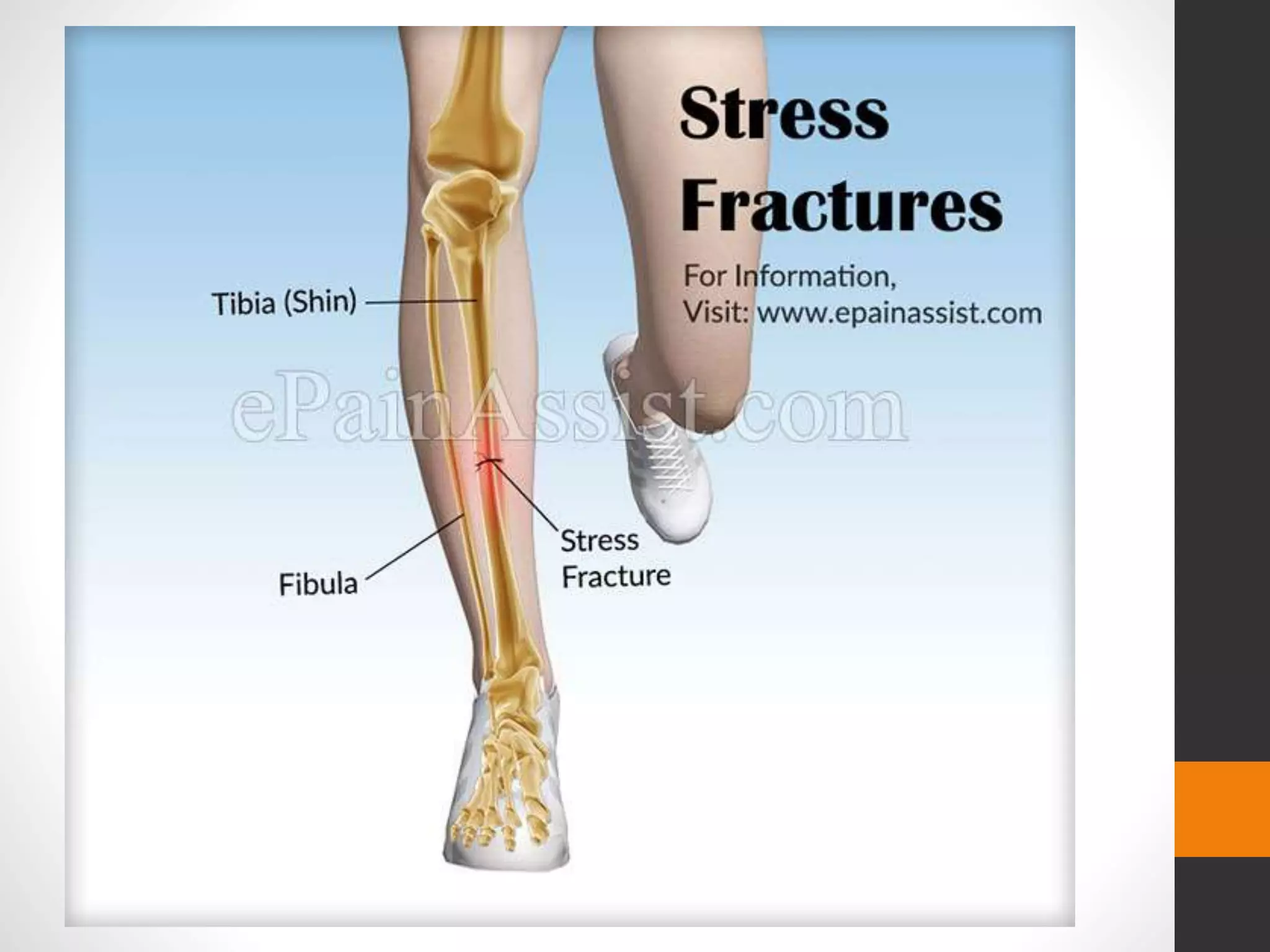 Common sports injuries | PPTX