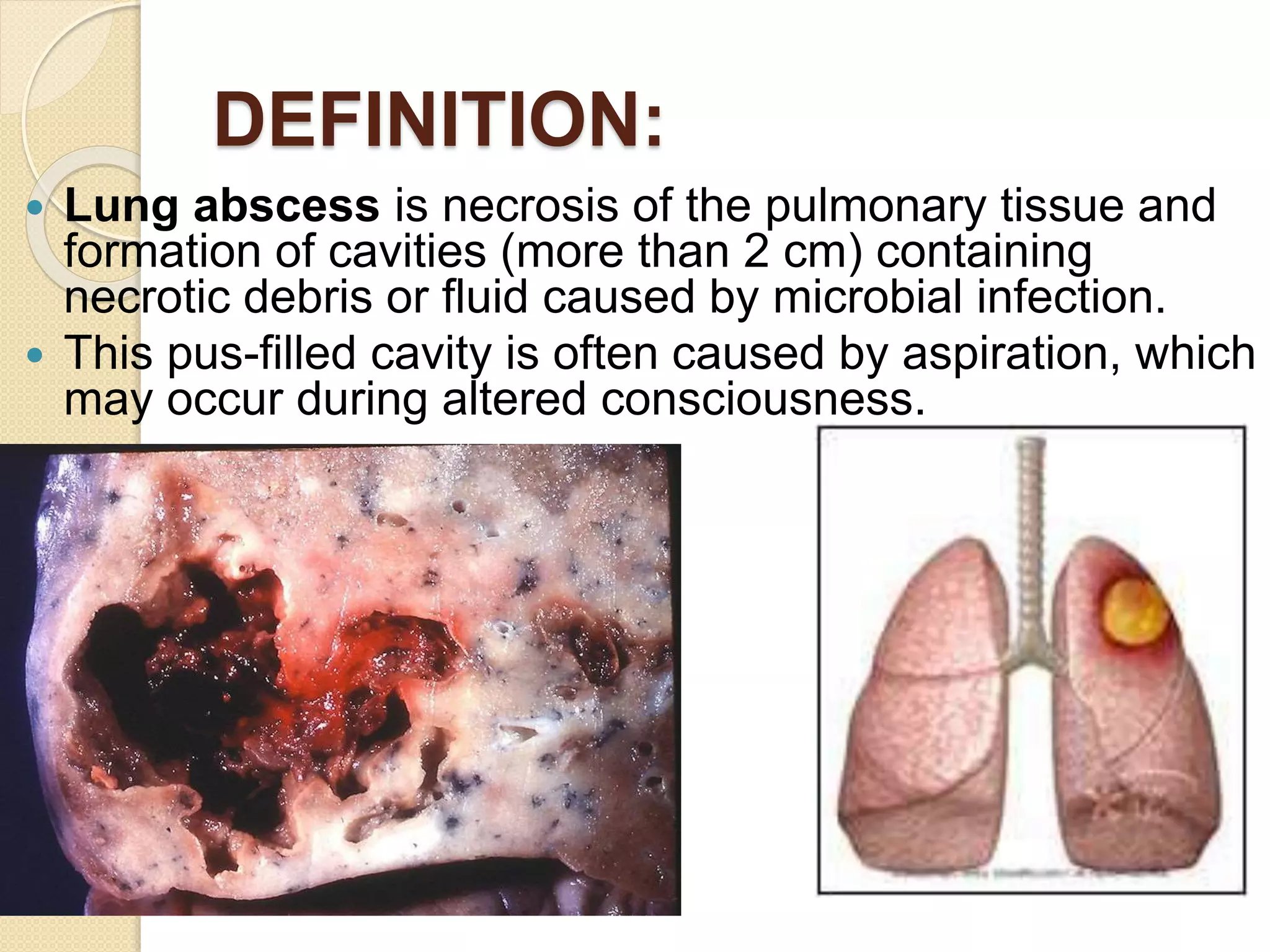 Common suppurative diseases of lung- Bronchiectasis...! | PPTX