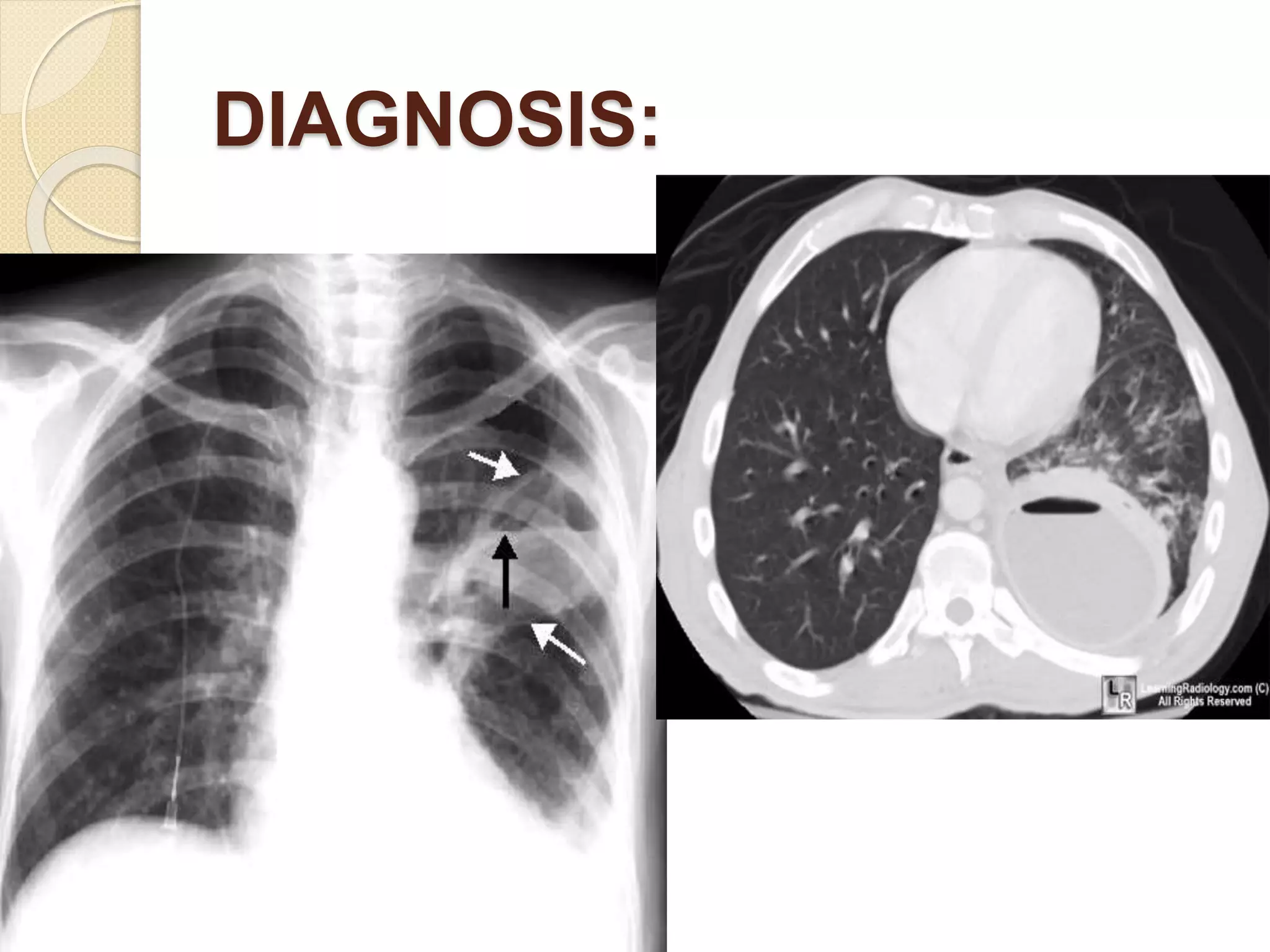 Common suppurative diseases of lung- Bronchiectasis...! | PPTX