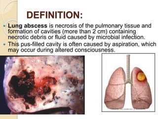 Common suppurative diseases of lung- Bronchiectasis...! | PPTX