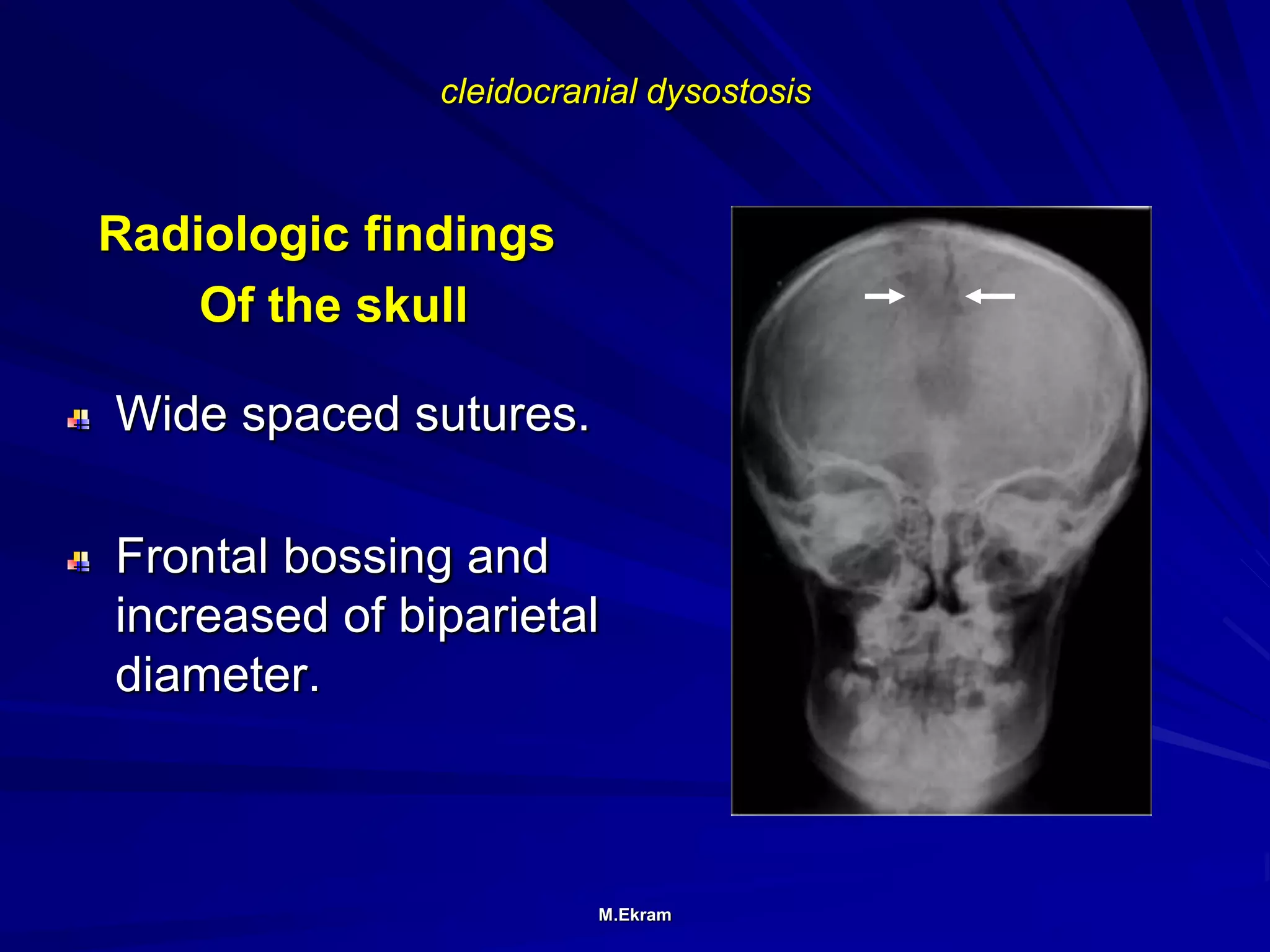 Common syndromes affecting the head & neck | PPT