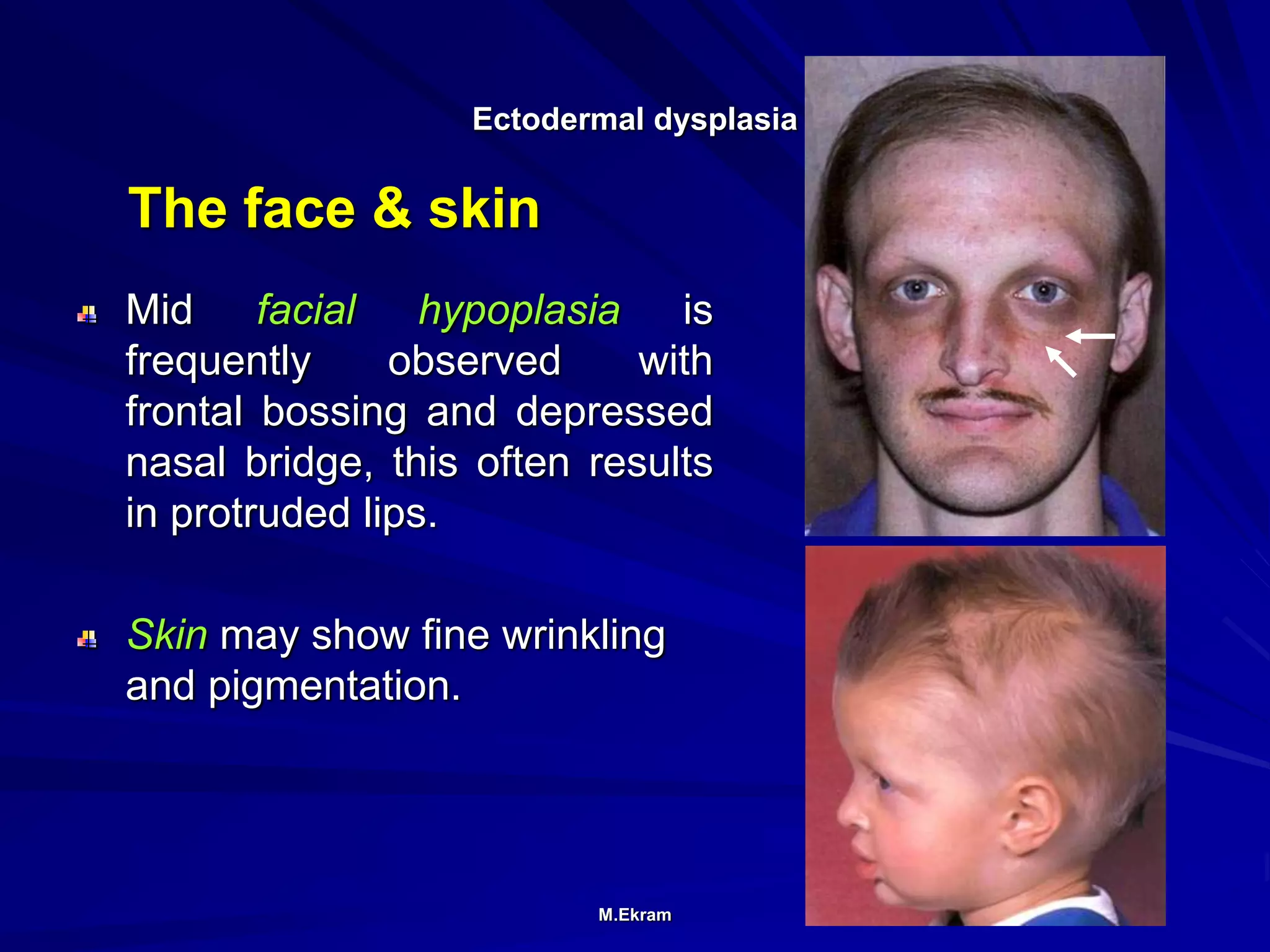 Common syndromes affecting the head & neck | PPT