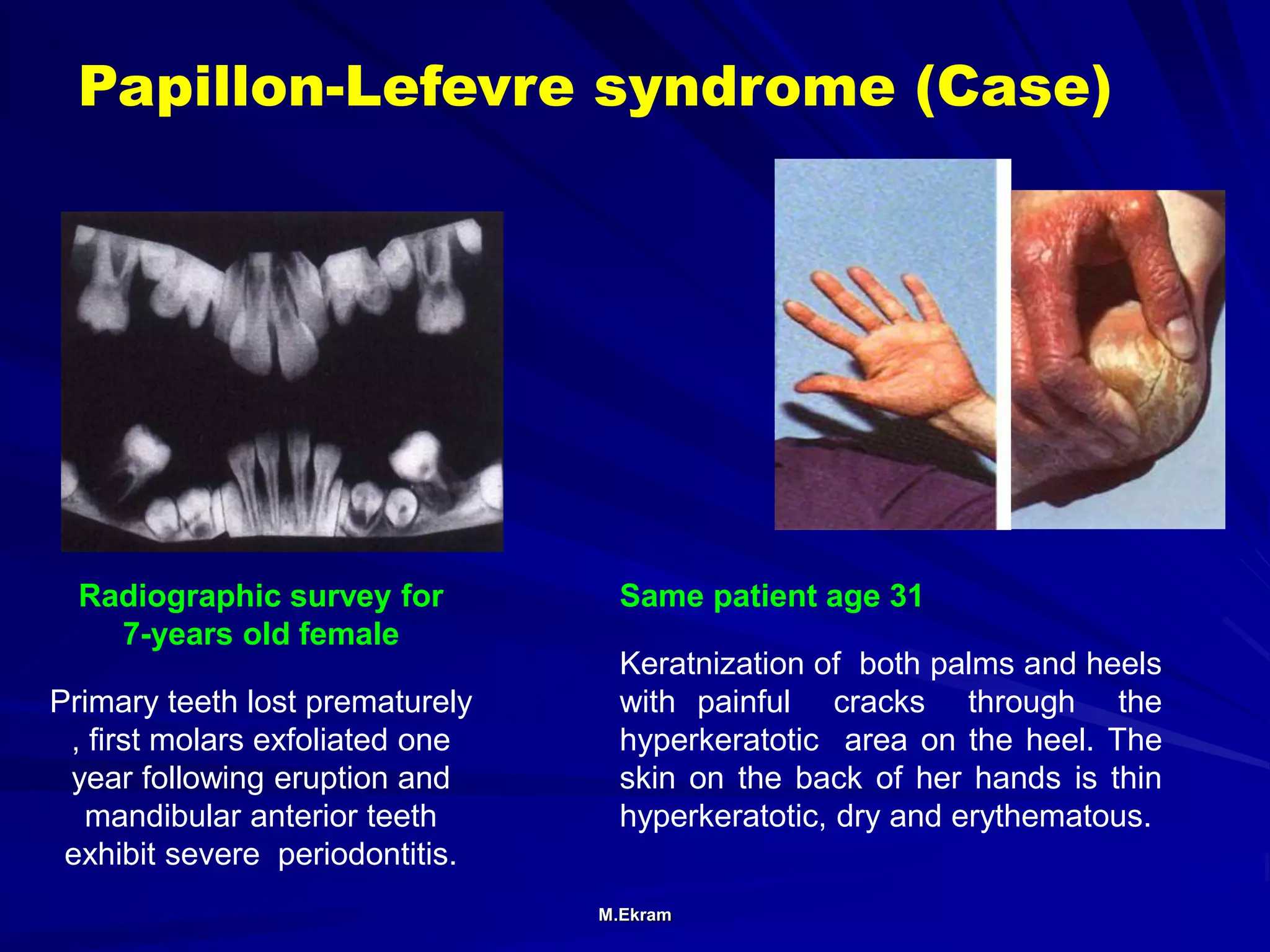 Common syndromes affecting the head & neck | PPT