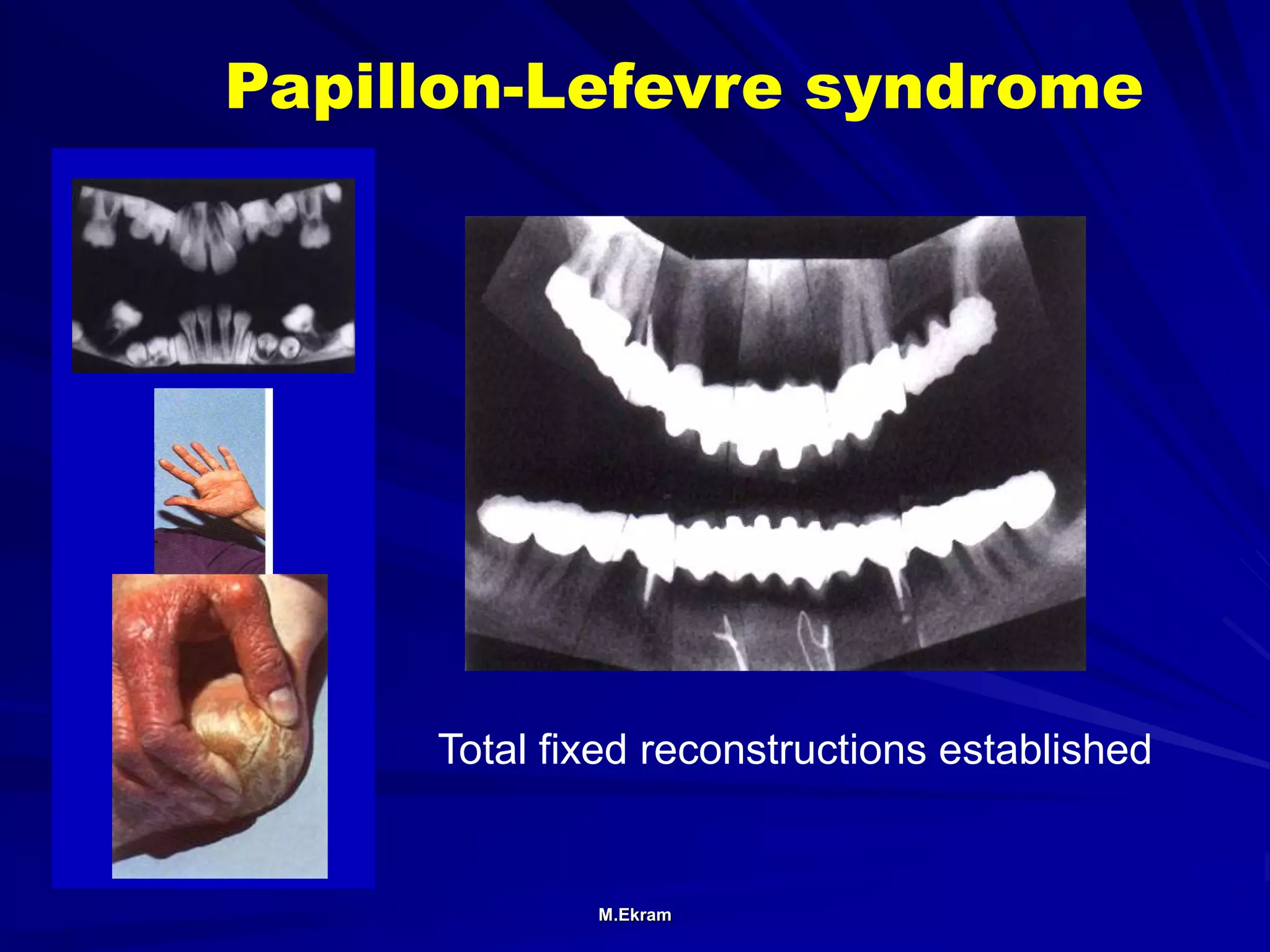 Common syndromes affecting the head & neck | PPT