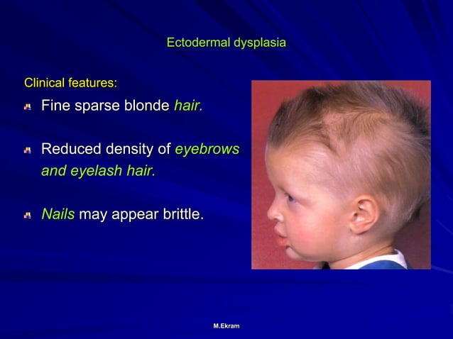 Common Syndromes Affecting The Head And Neck Ppt
