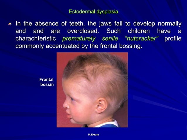 Common syndromes affecting the head & neck | PPT