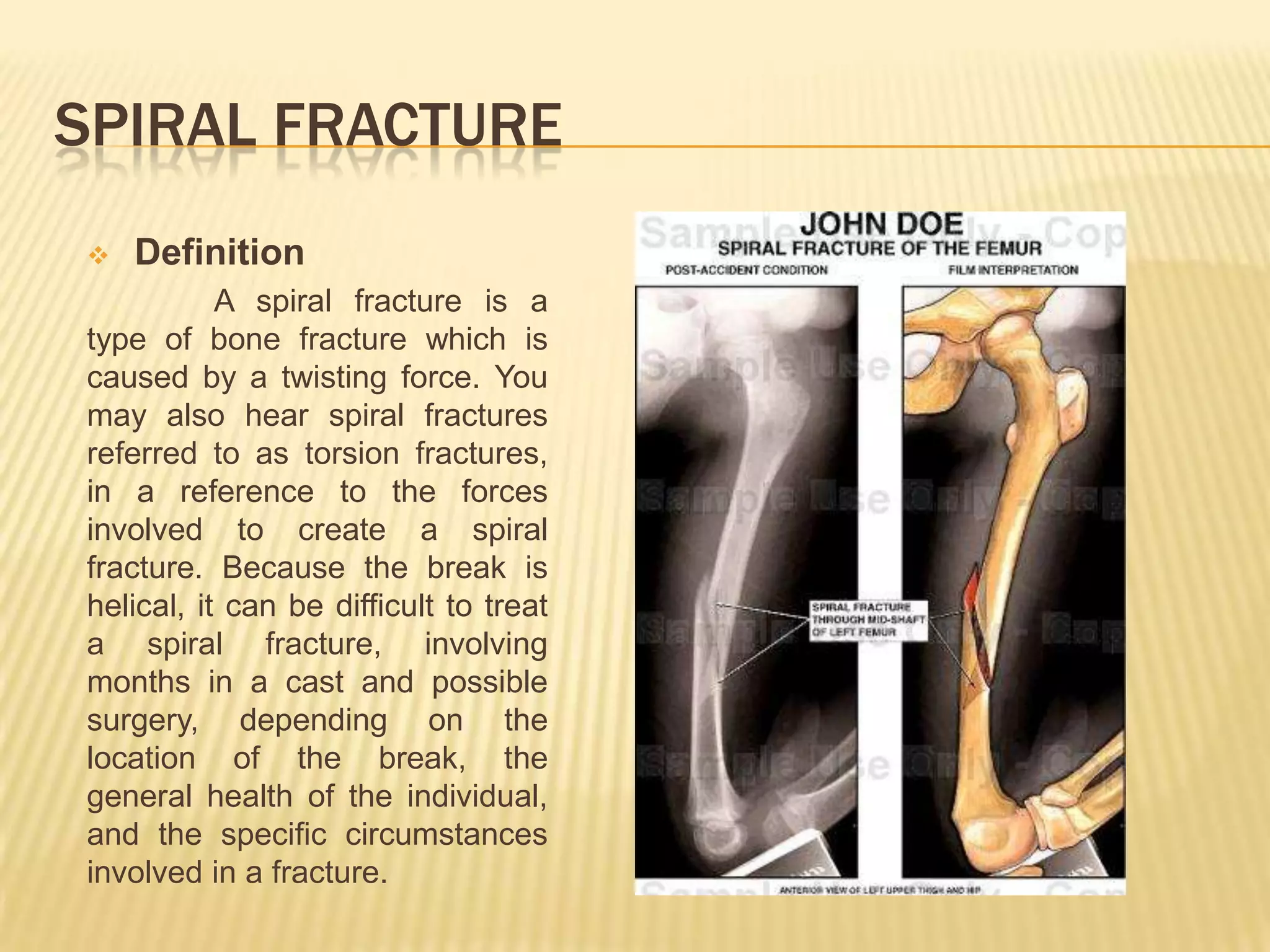 Common Types Of Fracture | PPTX