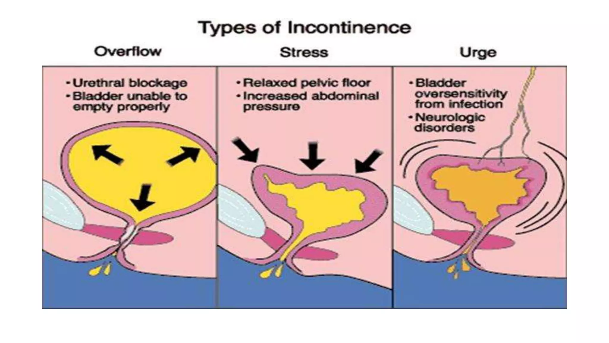 Common urological problems | PPTX