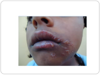 Comprehensive Overview of Common Viral Infections: HSV, Molluscum ...