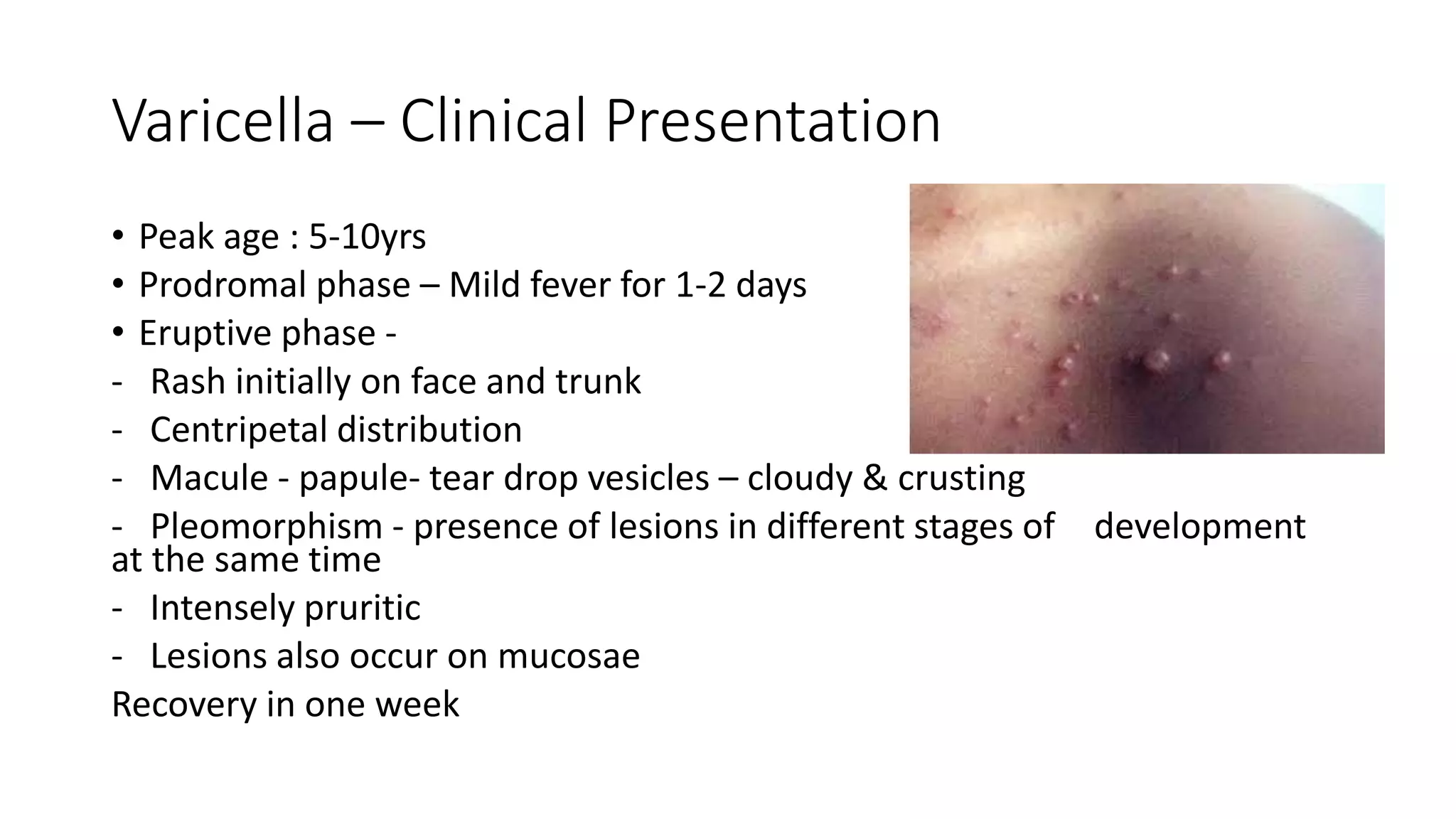 Common Viral Infections in children.pptx