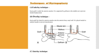 Chronic Otitis Media- mucosal type( UG) .pdf