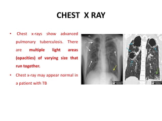 COMMUNICABLE DISEASES medical surgical nursing.pptx