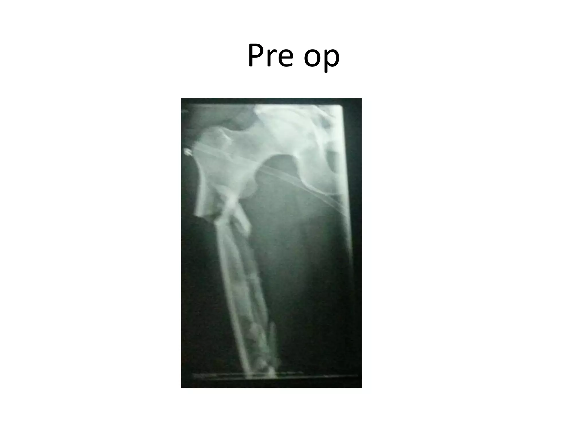 comminuted segmental fracture of femur shaft | PPTX