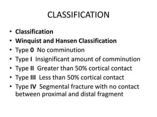 comminuted segmental fracture of femur shaft | PPT