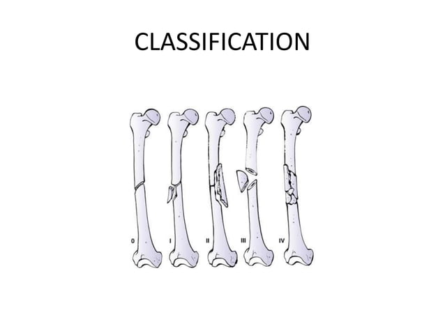 comminuted segmental fracture of femur shaft