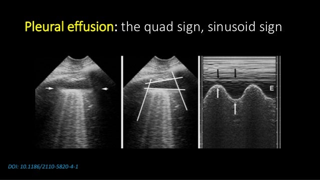Community acquired pneumonia (cap)