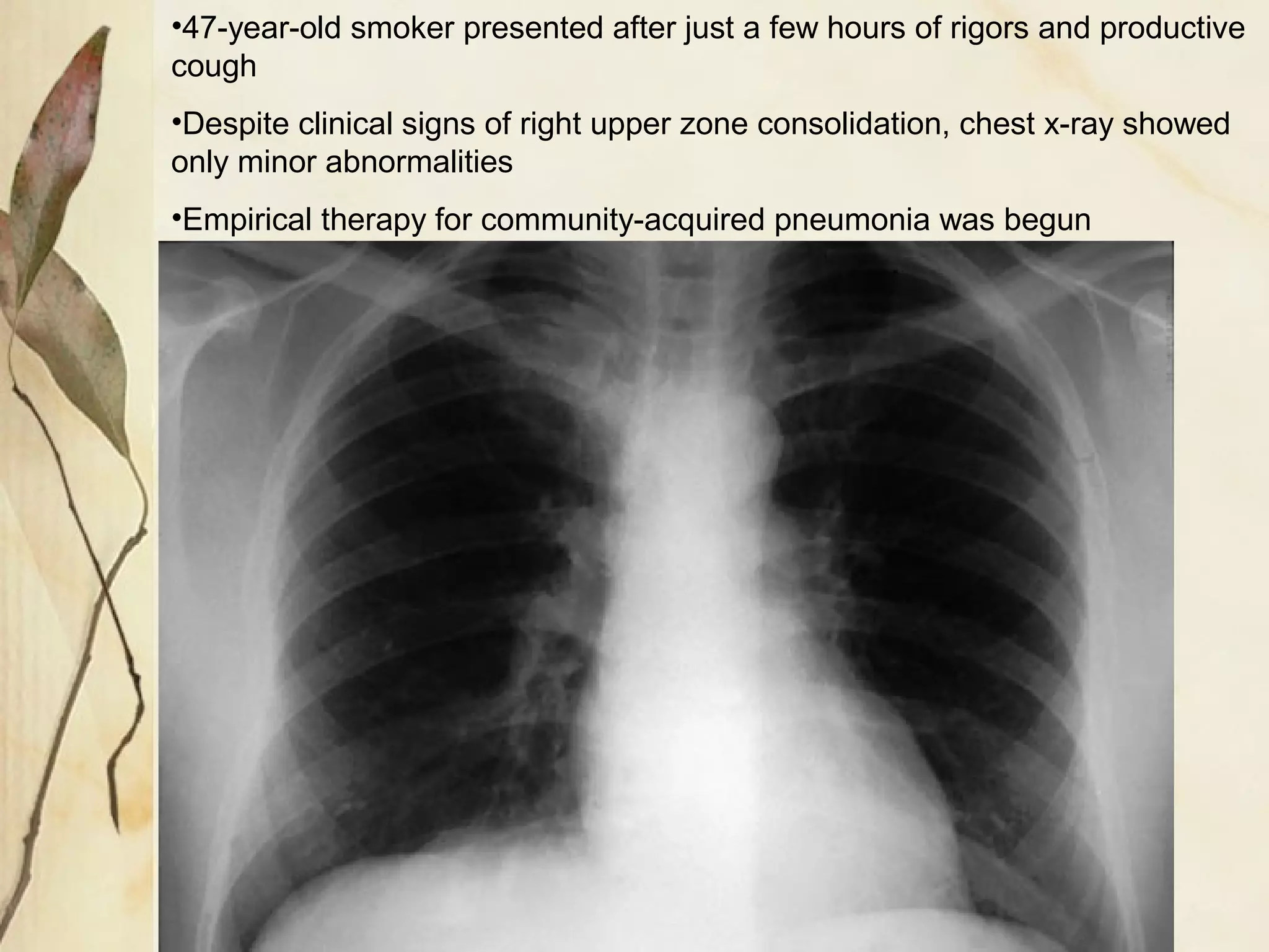 Community acquired pneumonia (cap) | PPT