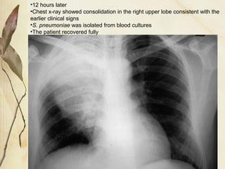 Community acquired pneumonia (cap) | PPT