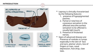 community medicine leprosy bechelor of physiotherapy.pptx | Infectious ...