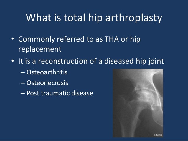 Community Minimally Invasive Total Hip Replacement Slideshow