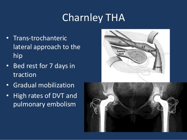 Community Minimally Invasive Total Hip Replacement Slideshow