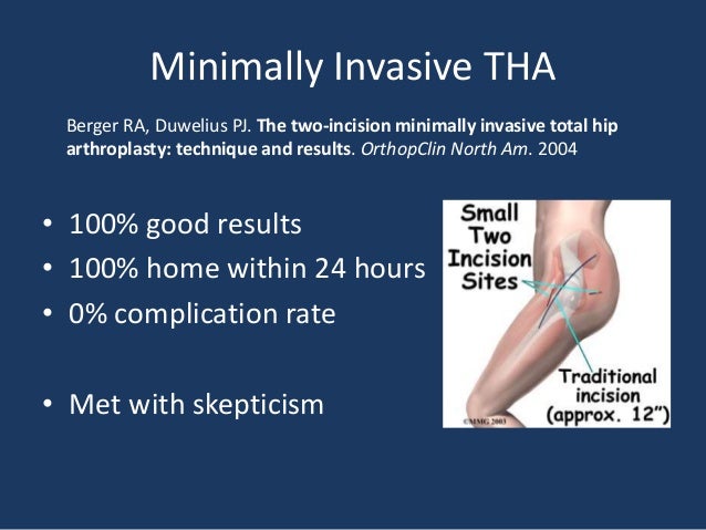 Community Minimally Invasive Total Hip Replacement Slideshow