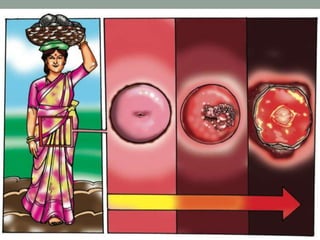 Community Mobilization for Cervical Screening Camps at SughaVazhvu ...