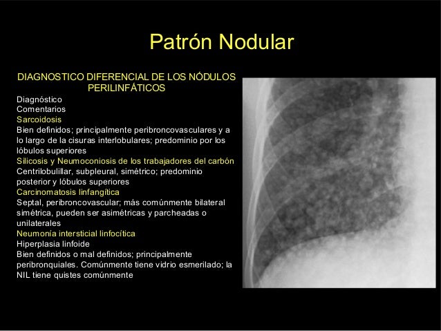 Como diagnosticar Neumoconiosis