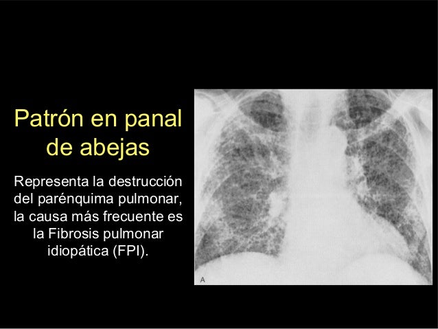 Como diagnosticar Neumoconiosis